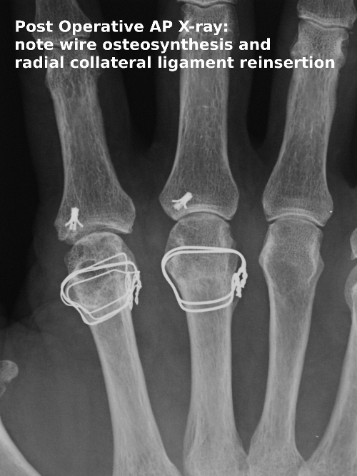 Metacarpal Shortening Osteotomy for the Metacarpophalangeal Rheumatoid ...